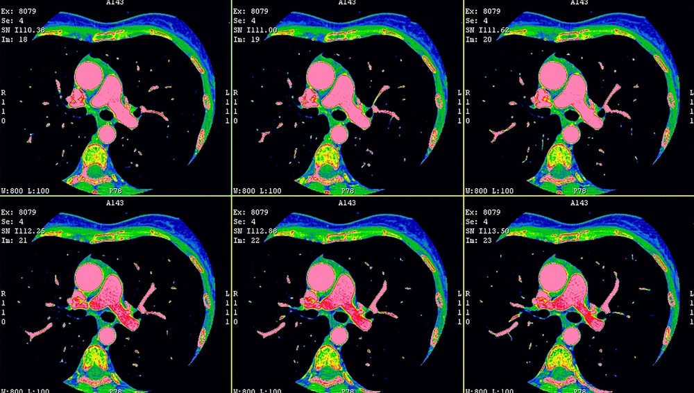 Cardiac CT Scan in Beaumont, Jasper, and Woodville, TX - ACS