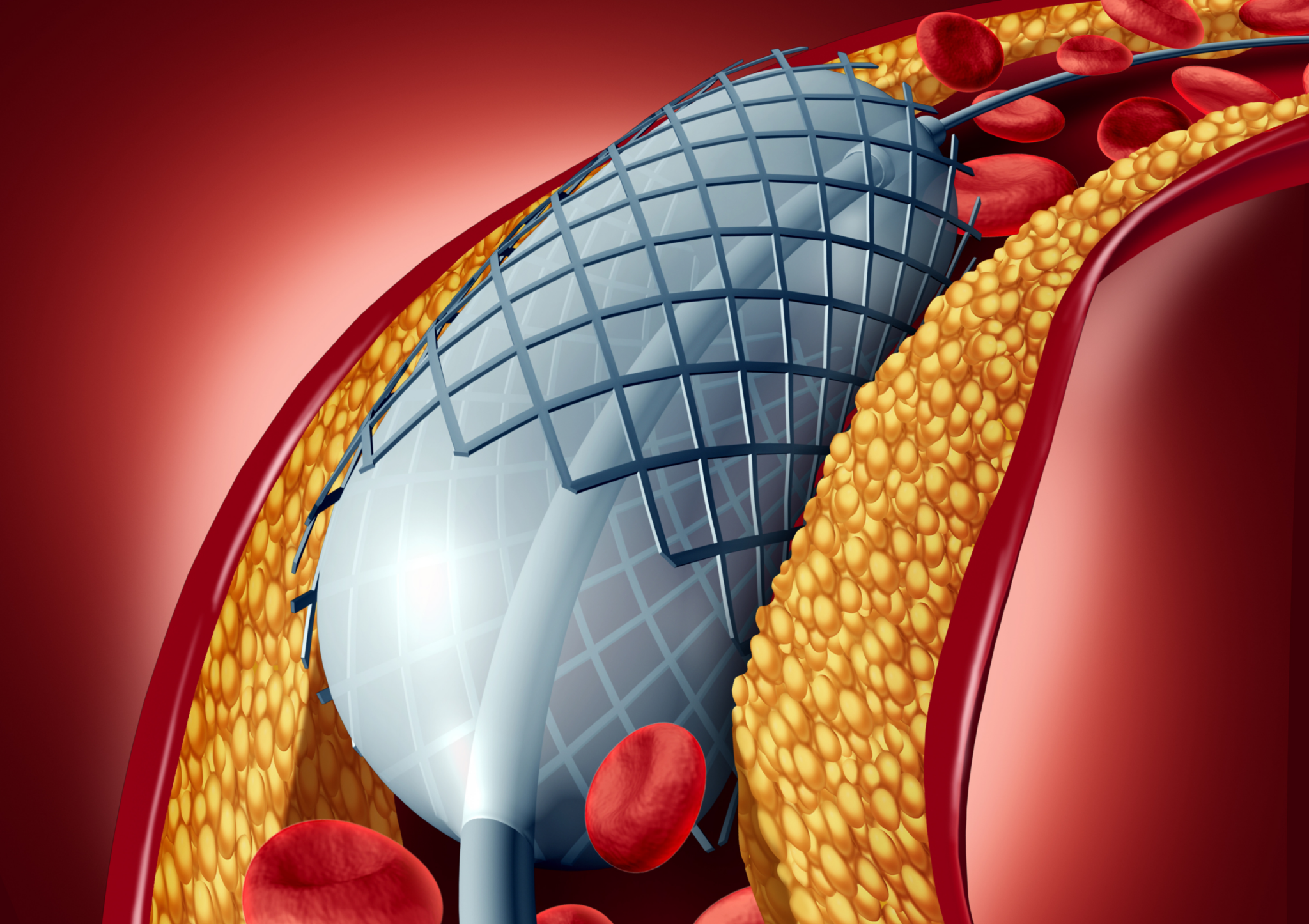 Life-Saving Benefits of Cardiac Stent Placement - Advanced ...